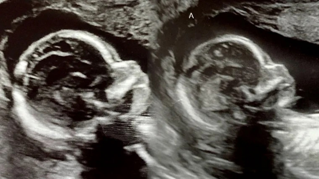 US woman with rare double uterus expecting babies in both | News